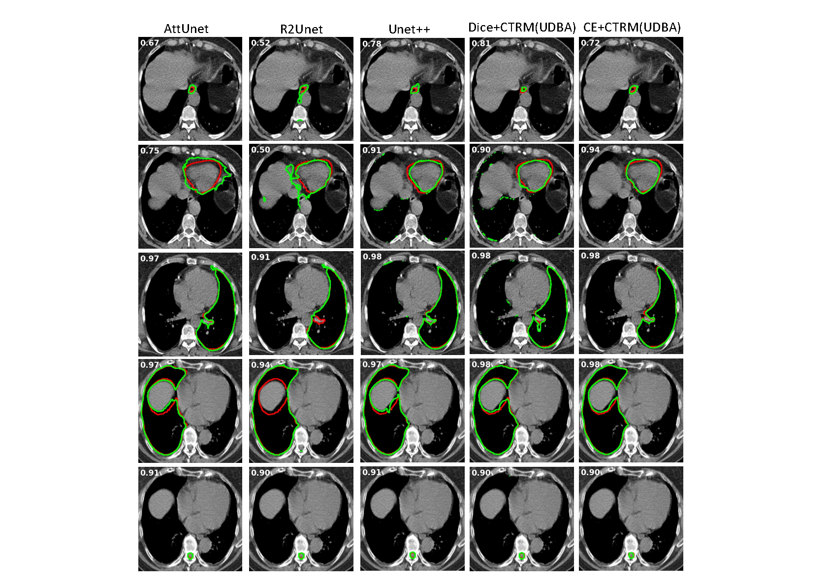 Uncertainty Driven Bottleneck Attention U-Net for Organ at Risk ...